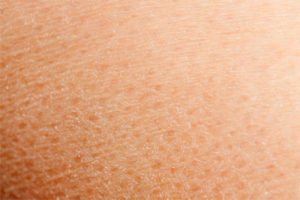 Prevent These Skin Issues by Softening Your Hard Water - Advanced Water ...